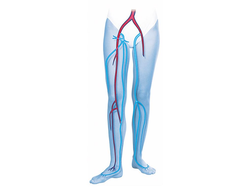Chronic Venous Insufficiency