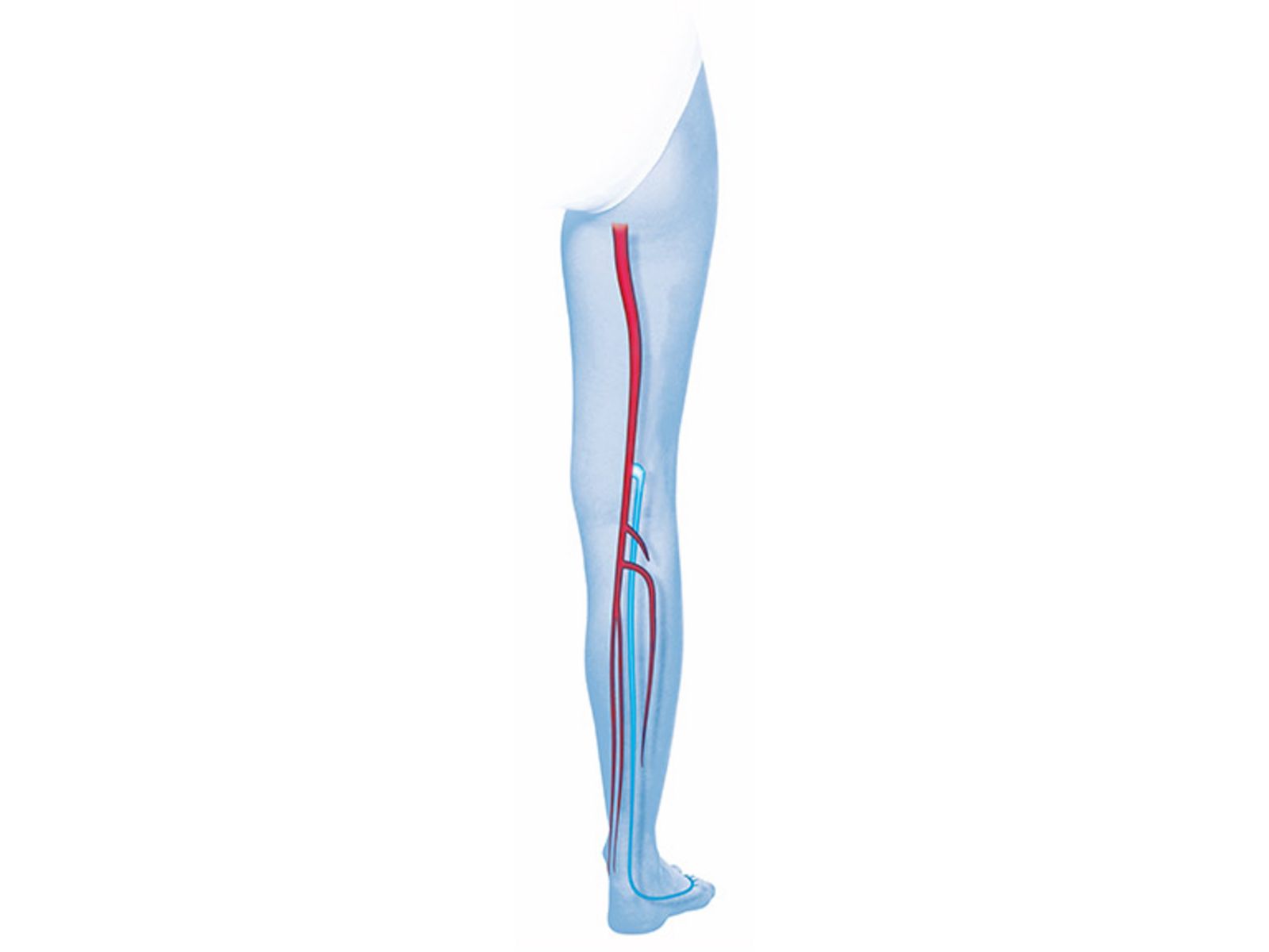 Chronic Venous Disease: Overview & Treatment